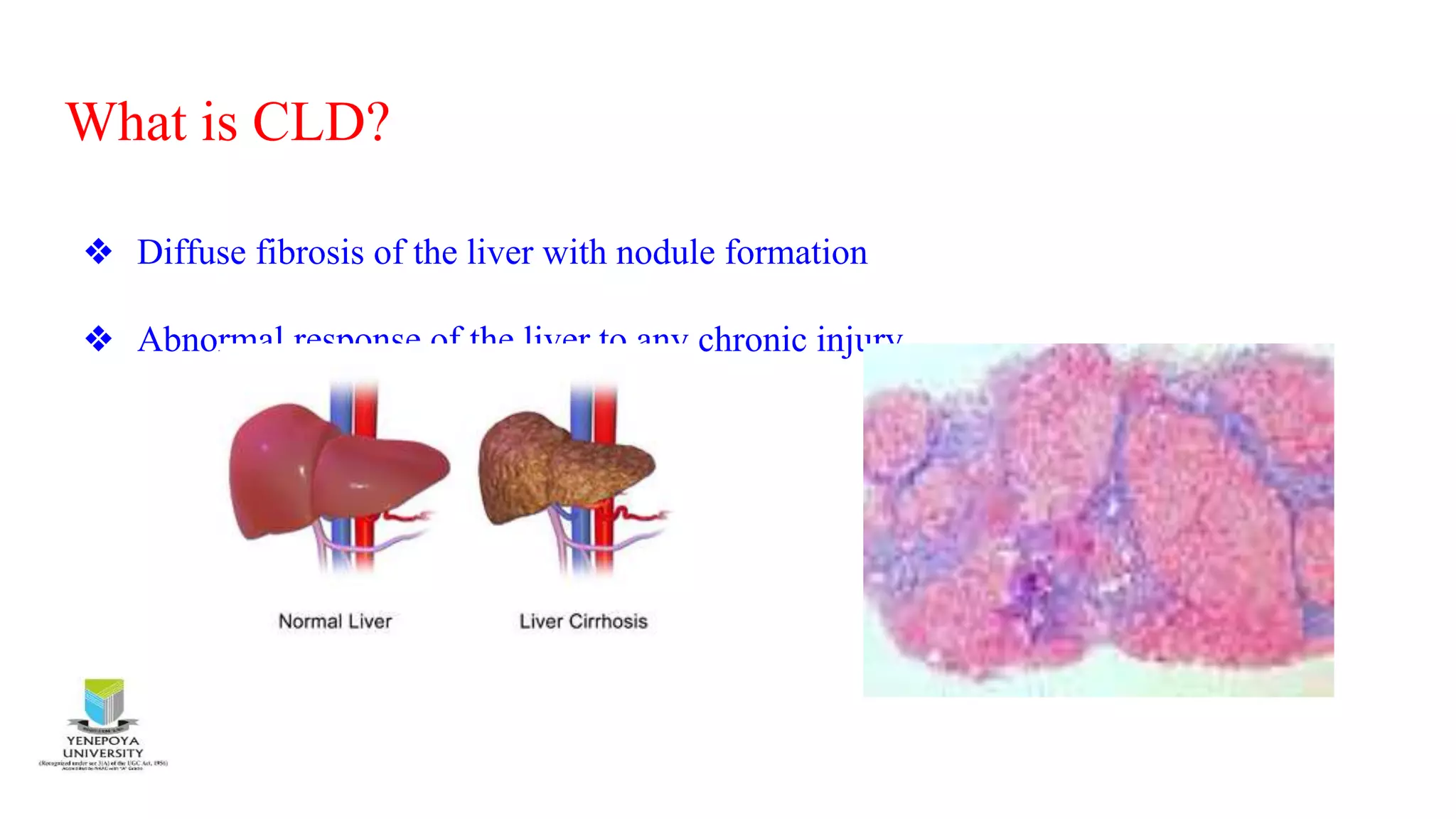 Chronic liver disease and it s complications | PPTX