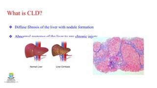 Chronic liver disease and it s complications | PPTX