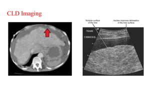 Chronic liver disease and it s complications | PPT