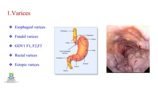 Chronic liver disease and its complication by Dr Ibrahim masoodi | PPTX
