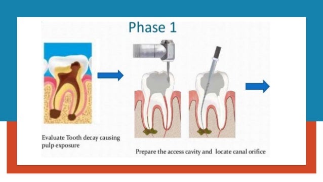 Cleaning and shaping of Root canal system