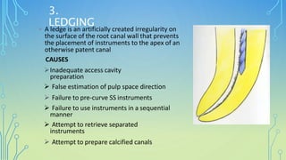 Cleaning and shaping of root canal systems | PPTX