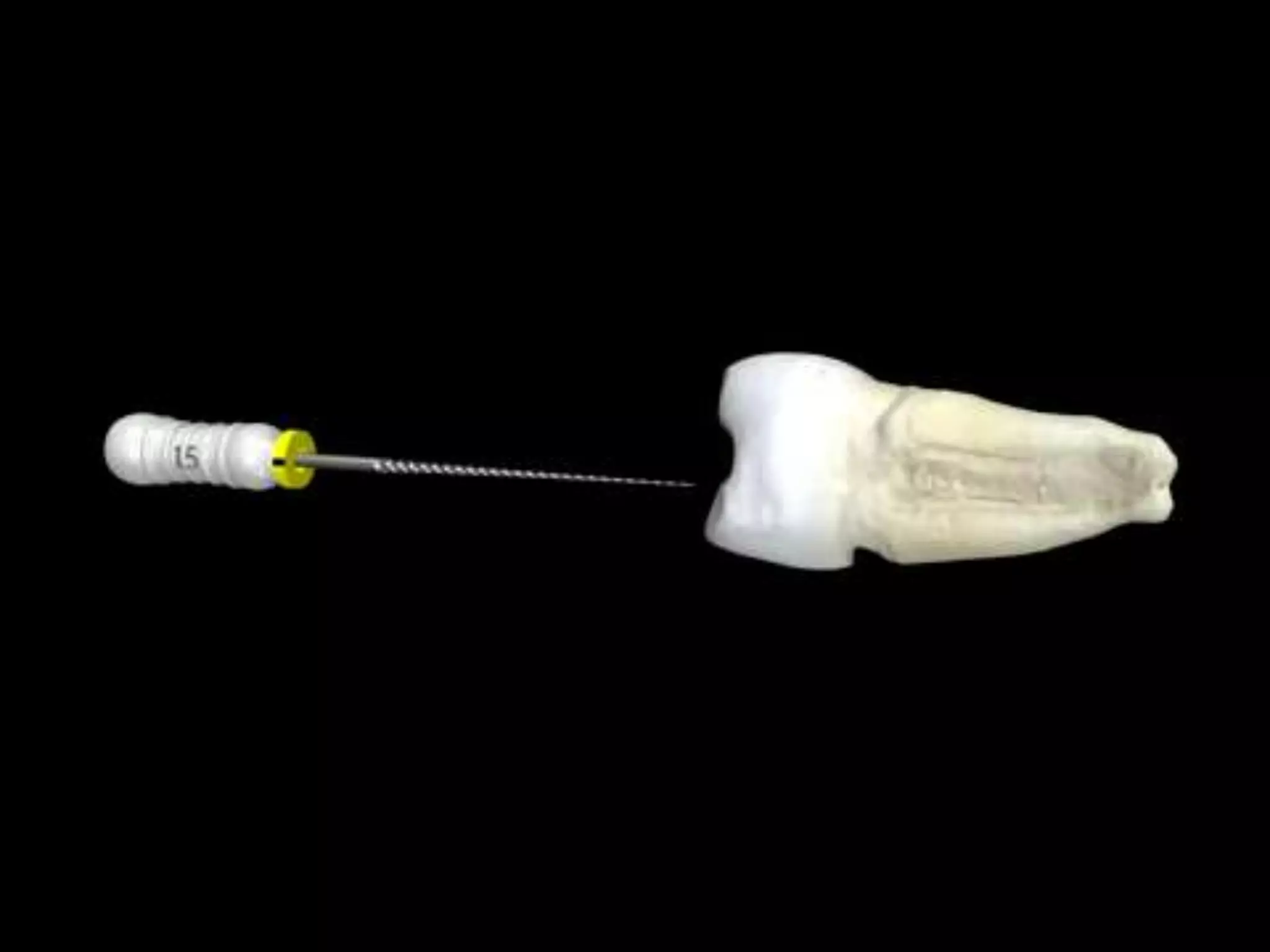 Cleaning and Shaping of Root Canal Systems | PPTX