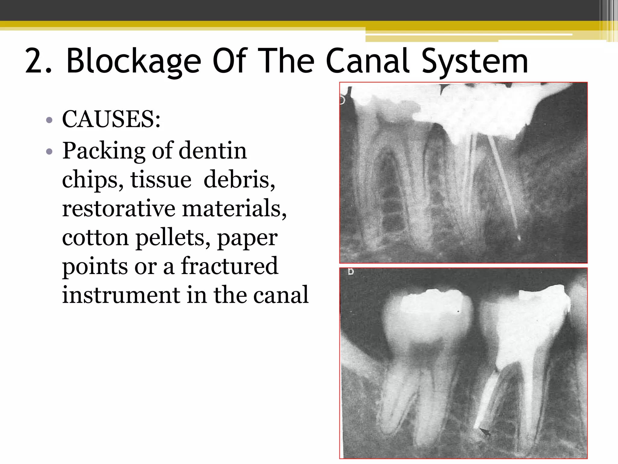 Cleaning and Shaping of Root Canal Systems | PPTX