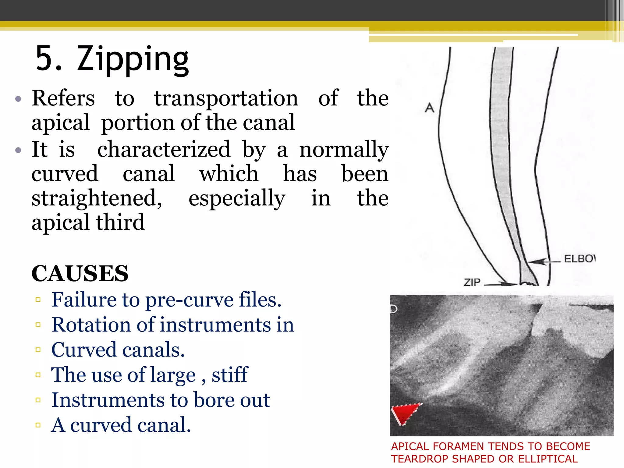 Cleaning and Shaping of Root Canal Systems | PPTX
