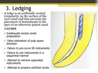 Cleaning and Shaping of Root Canal Systems | PPTX