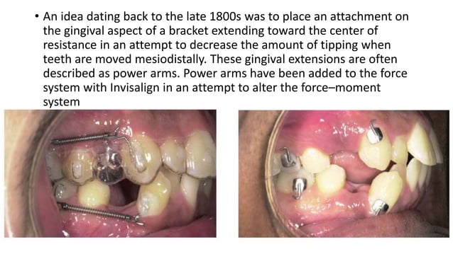 Clear aligner part ii | PPTX