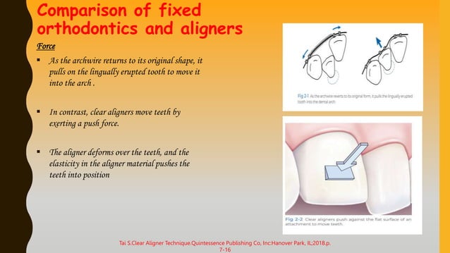 CLEAR ALIGNER THERAPY IN ORTHODONTICS .pptx | Oral care | Personal Care