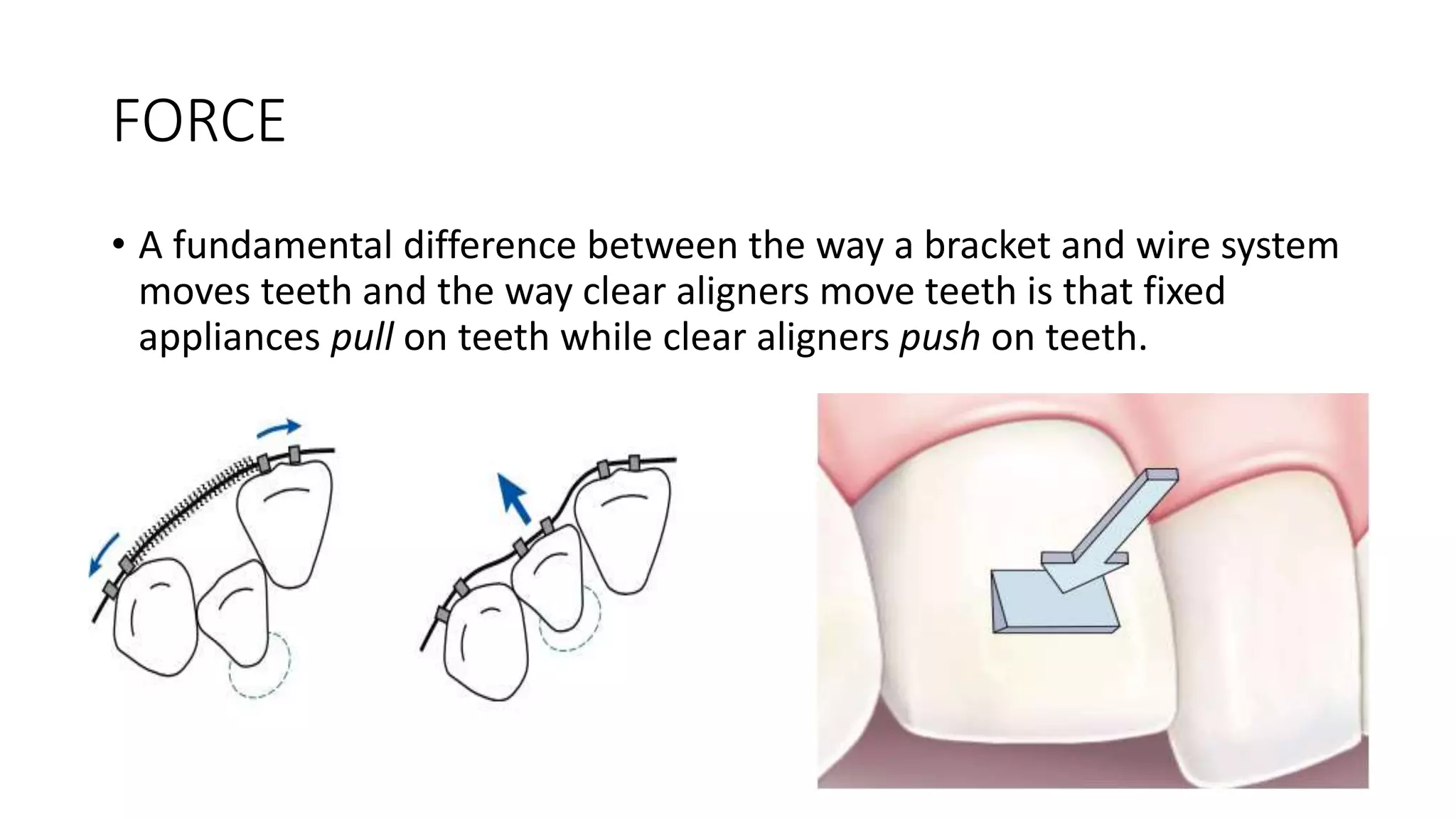 Clear aligner treatment | PPTX