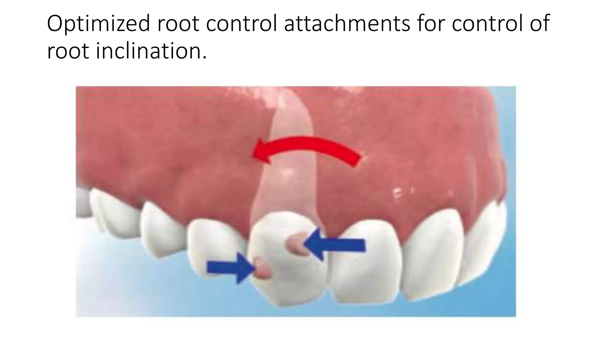 Clear aligner treatment | PPTX