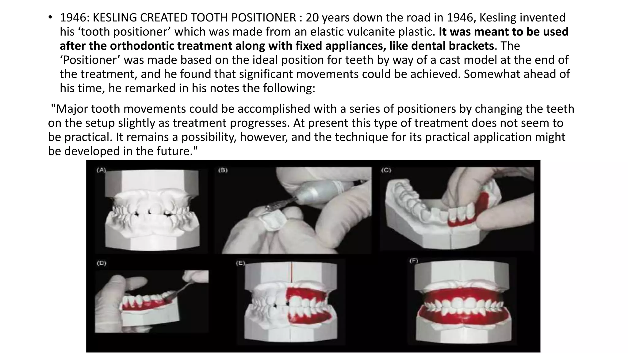 Clear aligner treatment | PPTX