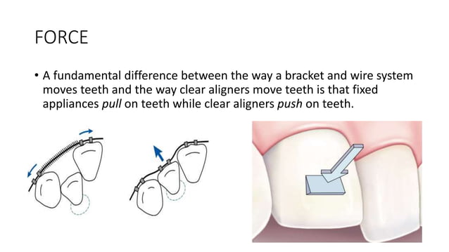 Clear aligner treatment | PPTX | Dental Health | Diseases and Conditions