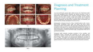 Shorten Invisalign Treatment by 10-20% without Acceleration. Invisalign ...