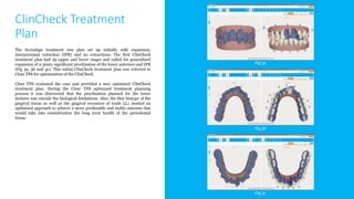 Shorten Invisalign Treatment by 10-20% without Acceleration. Invisalign ...
