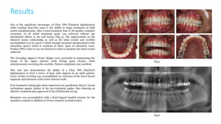 Shorten Invisalign Treatment by 10-20% without Acceleration. Invisalign ...