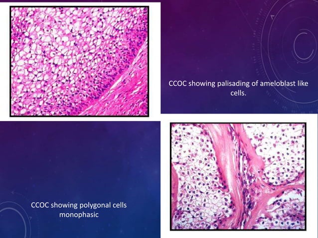 Clear cell lesions of head & neck. | PPTX | Dental Health | Diseases ...