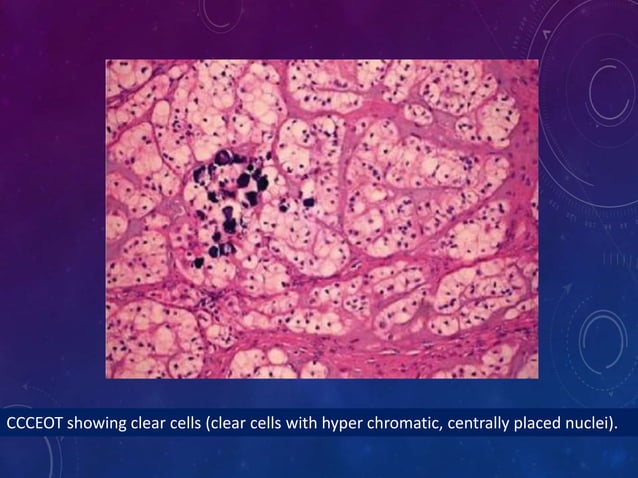 Clear cell lesions of head & neck. | PPTX | Dental Health | Diseases ...