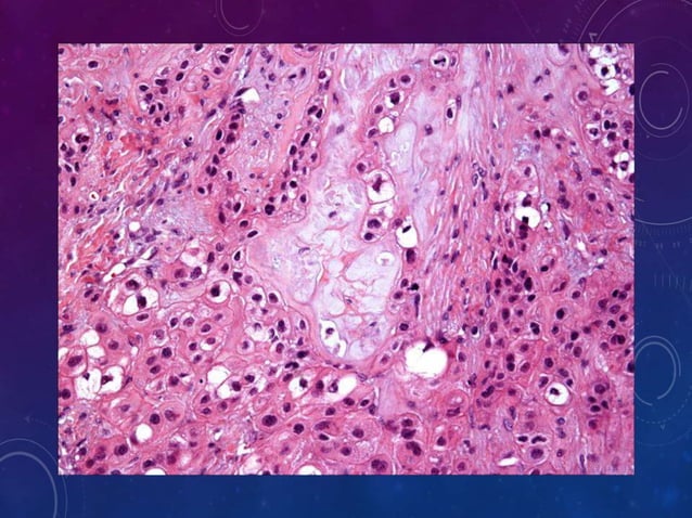 Clear cell lesions of head & neck. | PPTX | Dental Health | Diseases ...