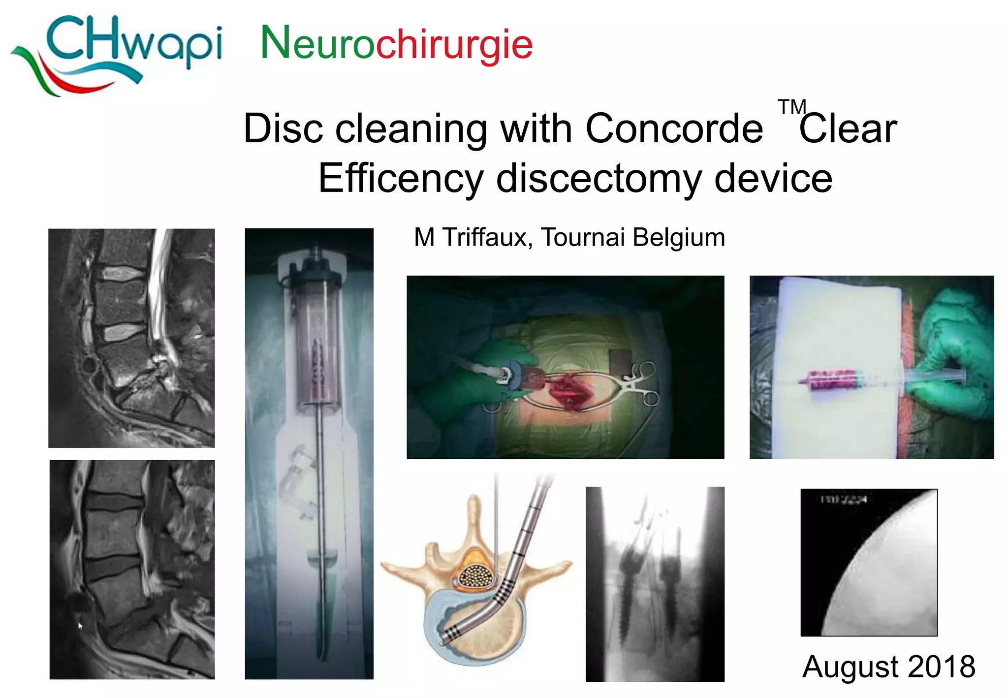 Lumbar discectomy device Concorde Clear | PPTX