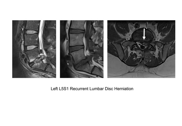 Lumbar discectomy device Concorde Clear | PPTX