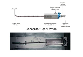Lumbar discectomy device Concorde Clear | PPTX