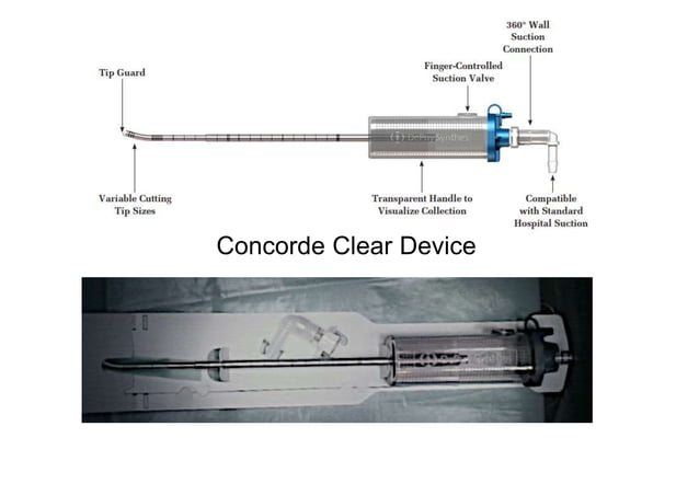 Lumbar discectomy device Concorde Clear | PPTX