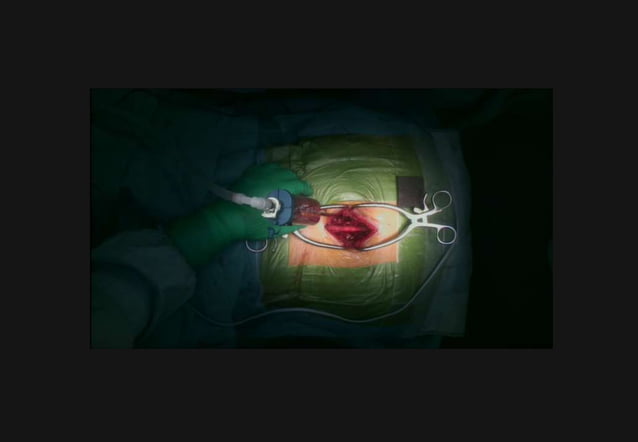Lumbar discectomy device Concorde Clear | PPTX