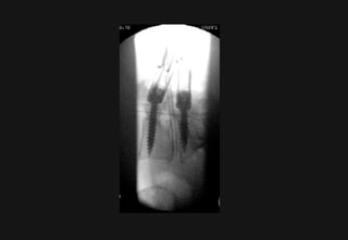 Lumbar discectomy device Concorde Clear | PPTX