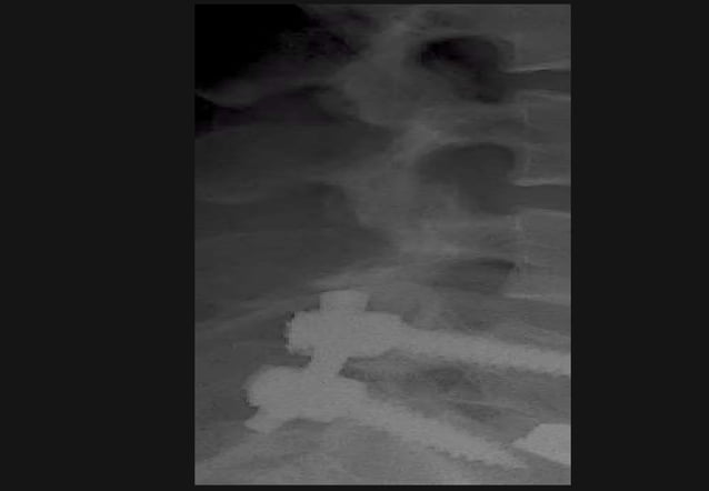 Lumbar discectomy device Concorde Clear | PPTX