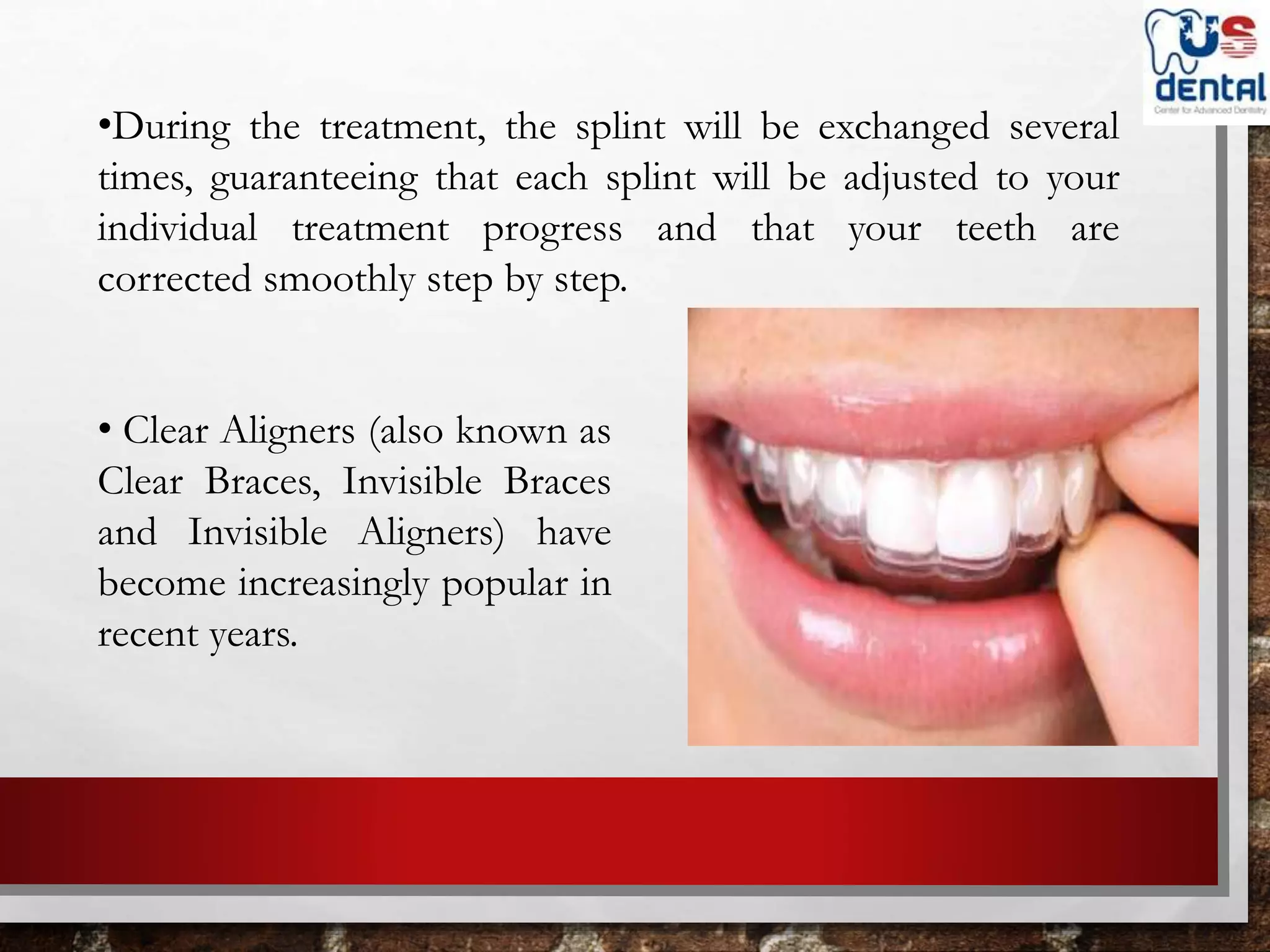 Clear Orthodontic Aligners | PPTX