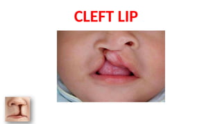 cleft lip.A medical student presentation | PPTX