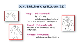 Management of Cleft Lip and Palate - Orthodontics | PPTX