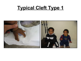 Cleft hand | PPT | Physical Therapy | Wellness