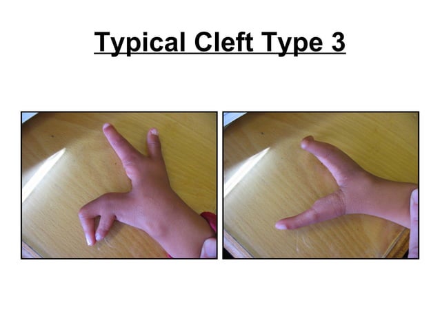 Cleft hand | PPT | Physical Therapy | Wellness