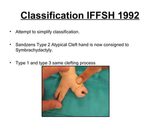 Cleft hand | PPT