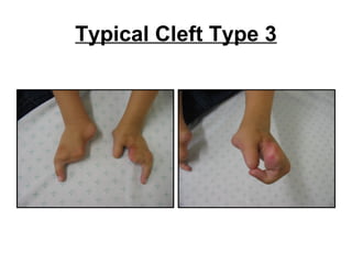 Cleft Hand