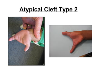Cleft Hand