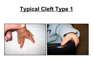 Cleft Hand