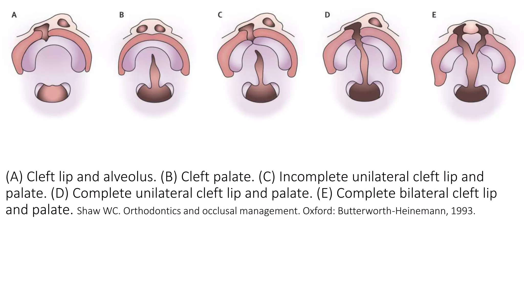 Cleft lip and palate from embryological development till maturity. | PPTX