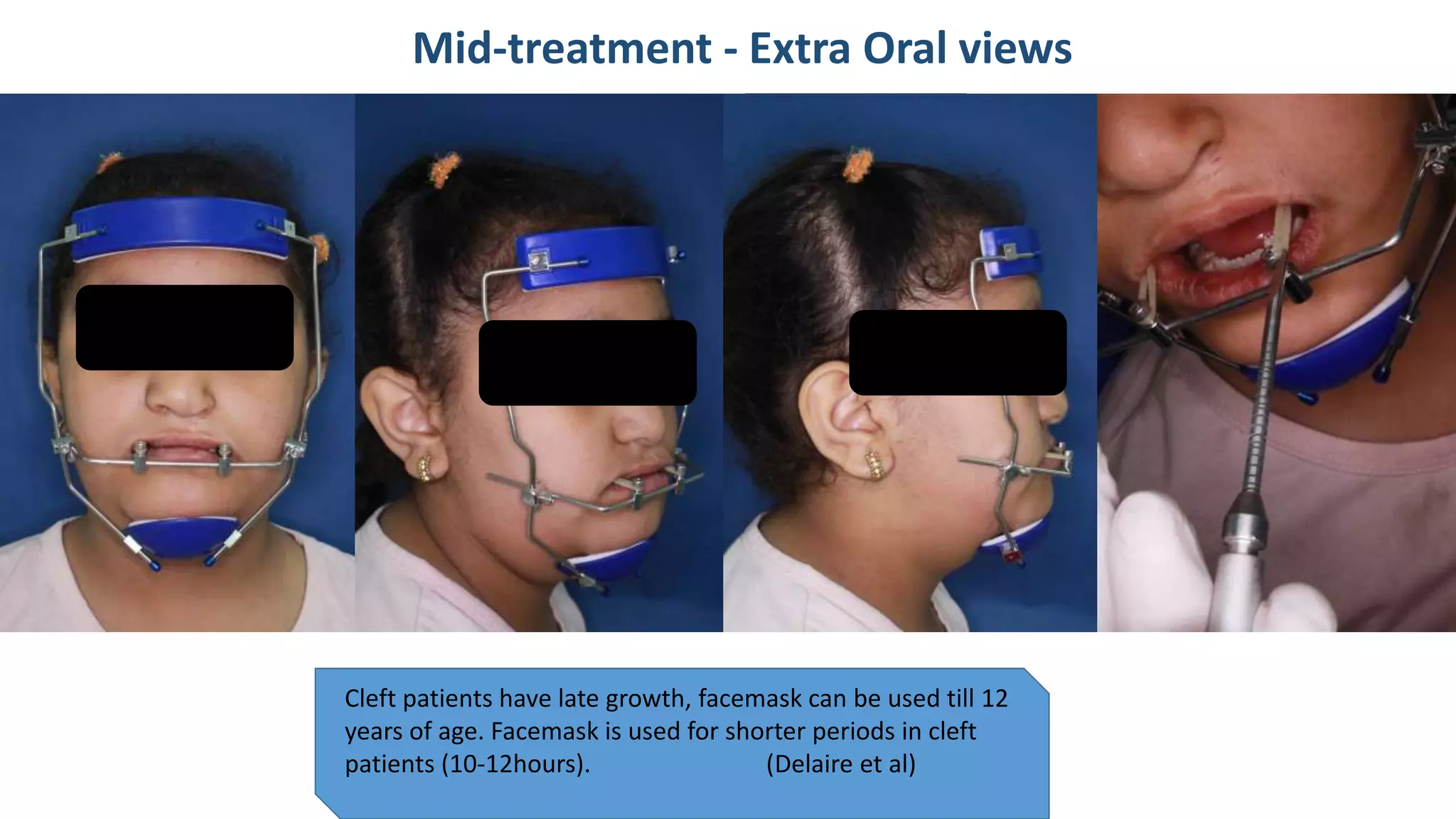 Cleft lip and palate from embryological development till maturity. | PPTX