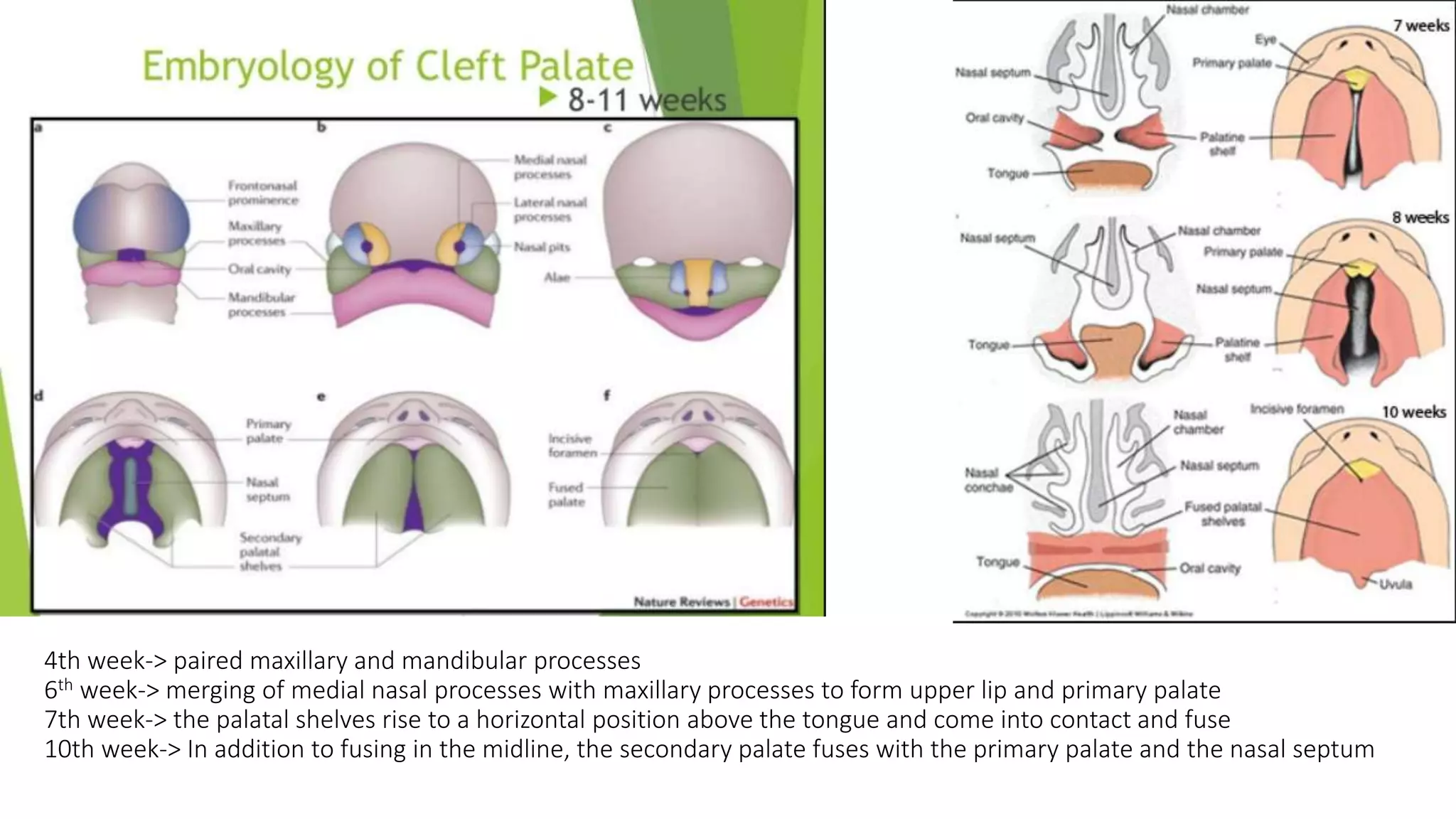 Cleft lip and palate from embryological development till maturity. | PPTX
