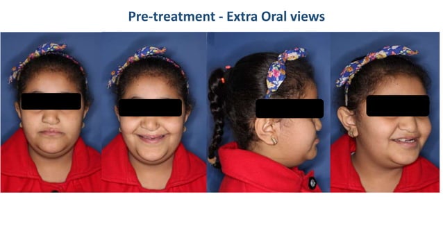 Cleft lip and palate from embryological development till maturity. | PPTX