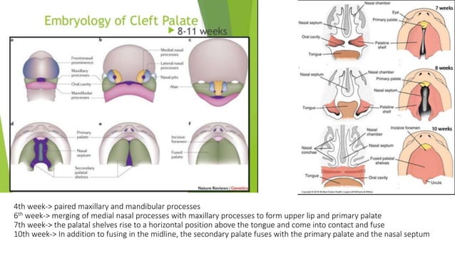 Cleft lip and palate from embryological development till maturity. | PPTX