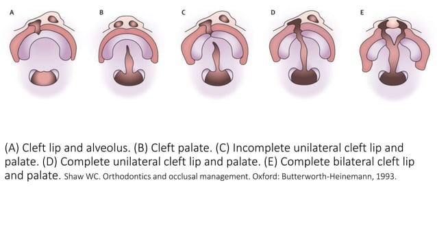 Cleft lip and palate from embryological development till maturity.