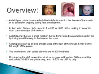 Cleft lip | PPT