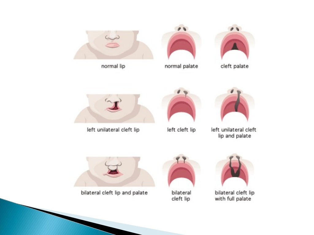 Cleft lip