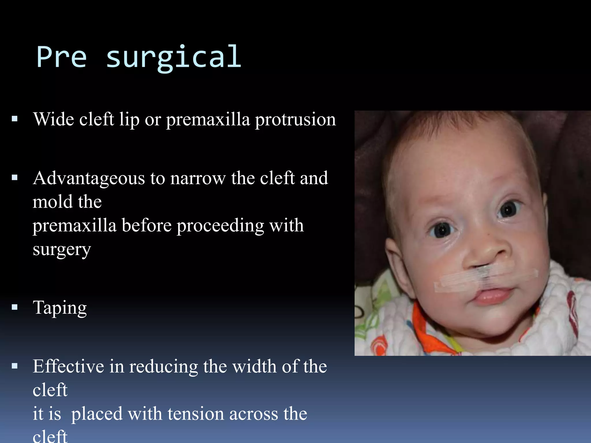 Cleft lip and Cleft palate embryology, features, and management | PPTX