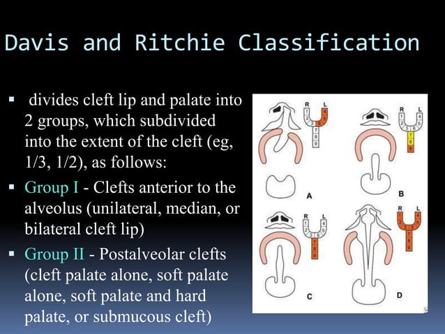 Cleft lip and Cleft palate embryology, features, and management | PPT