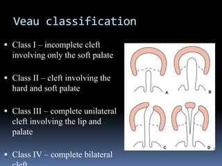 Cleft lip and Cleft palate embryology, features, and management | PPTX