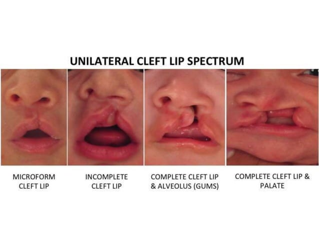 Cleft lip and Cleft palate embryology, features, and management | PPTX